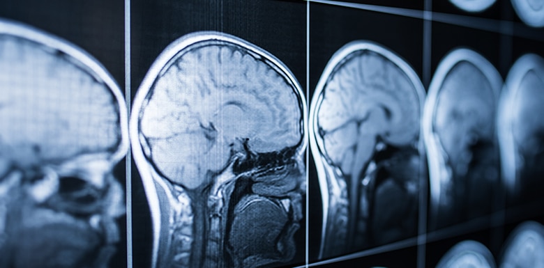 What's the Average Brain Injury Settlement in Odessa, TX? - Kemmy Law Firm